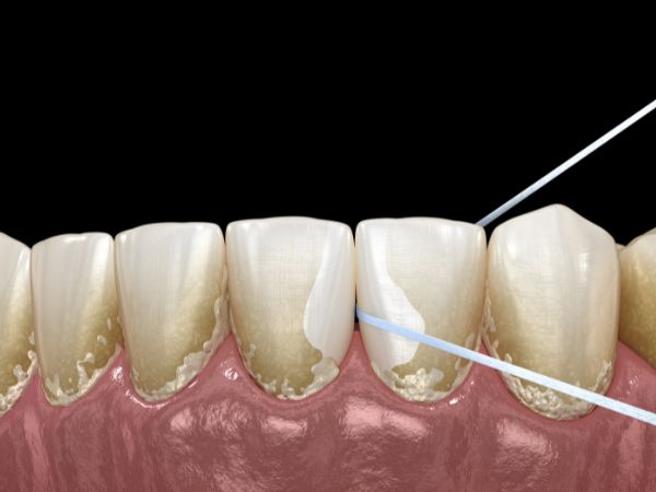 ¿Qué es la placa bacteriana y cómo prevenirla? | Clinica Dental Seis